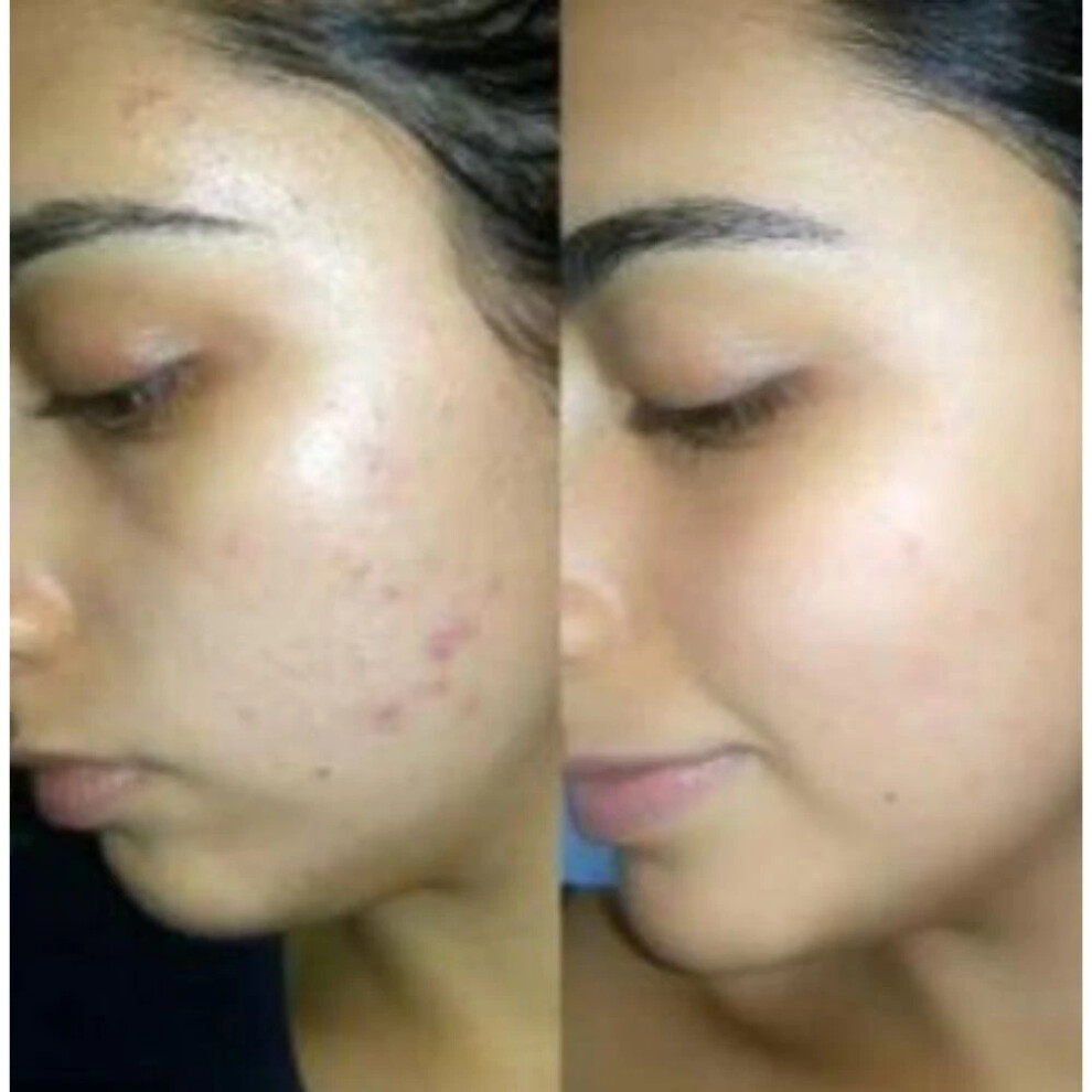 Expigment Cream 4% Melasma Meloan Hyperpigmentation Skin-bleaching on OnBuy