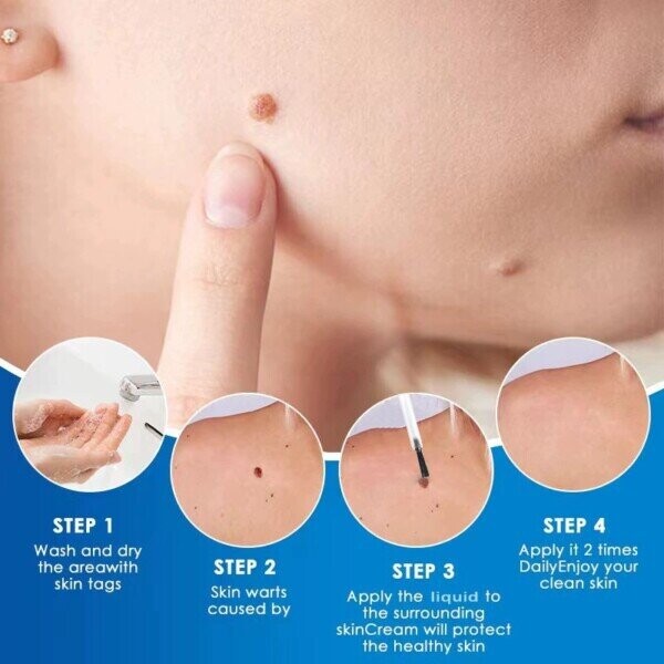 Skin Tag Remover Cream Painless Mole Skin Dark Spot Warts Remover on OnBuy