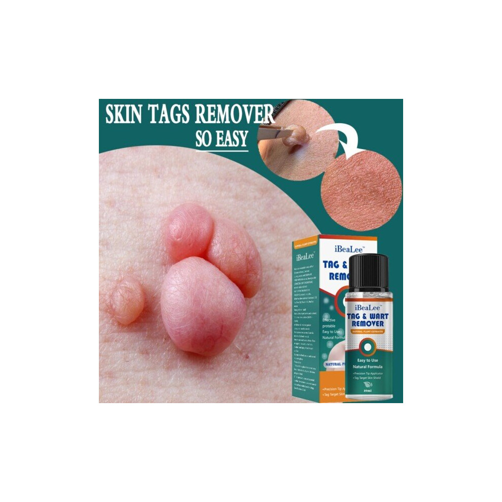 Skin Tag Remover Cream Painless Mole Skin Dark Spot Warts Remover on OnBuy