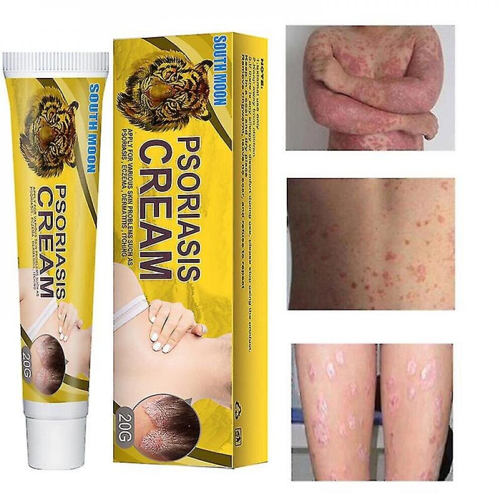 Skin Psoriasis Cream Dermatitis Eczematoid Eczema Ointment Treatment Psoriasis Dermatitis Fungal ...