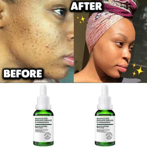 Succinic Acid Fast Acne Treatment Serum Facial Acne Scars And Dark ...