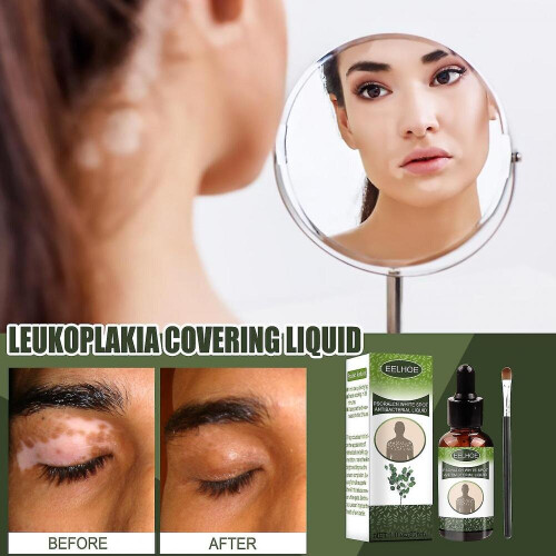 White Spot Cleansing Spray White Spot Antibacterial Liquid Skin Blemish ...