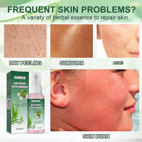 Aloe Vera Extract After Sun Repair Sunburn Sun Redness Redness Acne ...