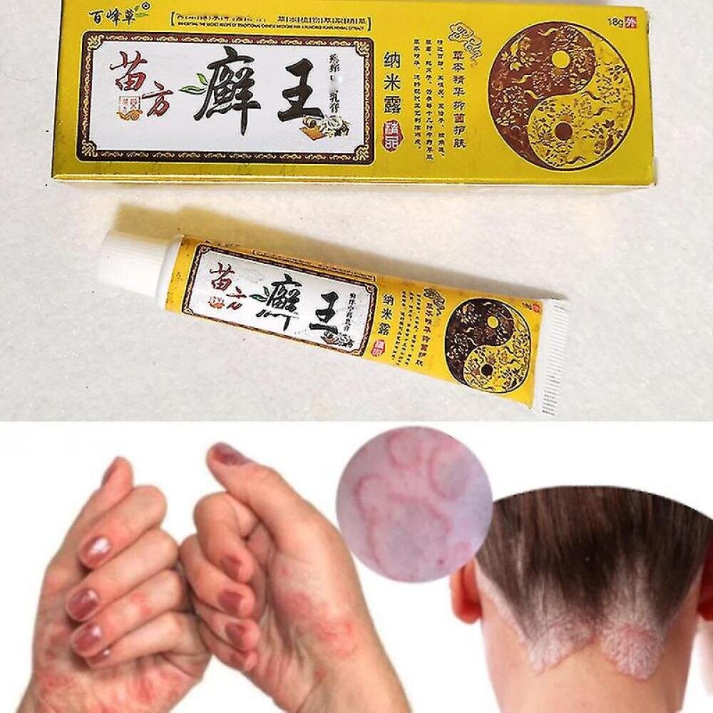 Herbal Ringworm Ointment Fights Ringworm On Skin Powerful Topical ...