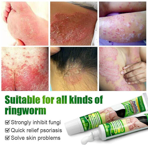 Kanyehb Ringworm Ointment Skin Topical Moss Ointment 20g on OnBuy