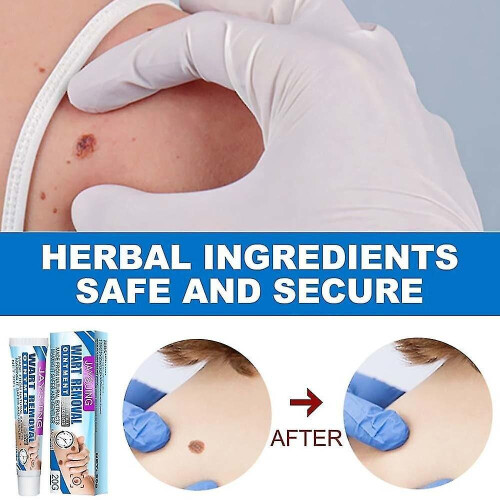 Skin Wart Spot Nevus Remover Cream Painless Mole Dark Spot Warts ...