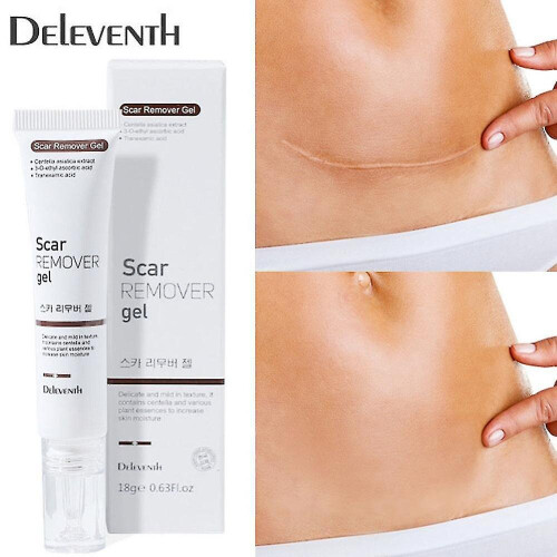 Tib Scar Removal Cream Pimples Acne Scars Remove Gel Fade Stretch Marks Burn Surgical Scars ...