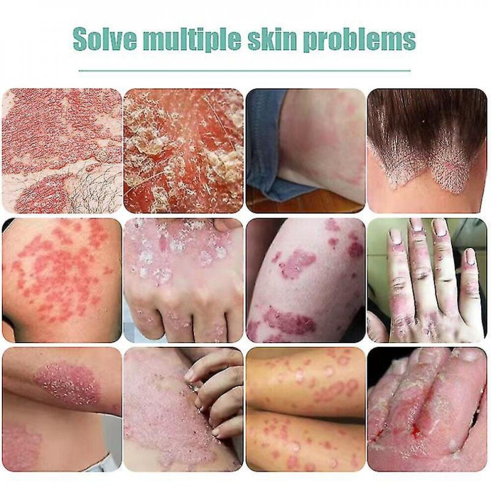 Skin Psoriasis Cream Dermatitis Eczematoid Eczema Ointment Treatment Psoriasis Dermatitis Fungal ...