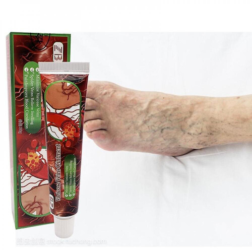30g Varicose Cream Relief Pain For Vasculitis Phlebitis Tube Varicose ...