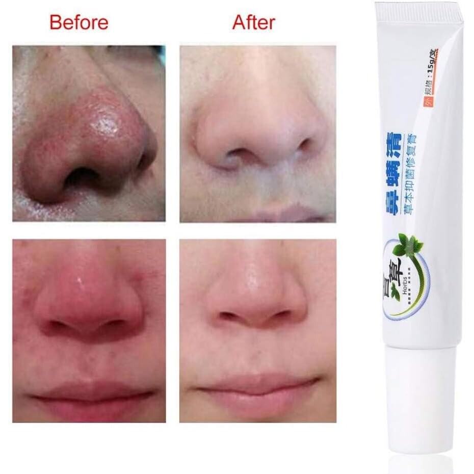 Rosacea Cream Treatment Skin Care Pores Products for Face Redness Relief, Inflammatory & Anti ...