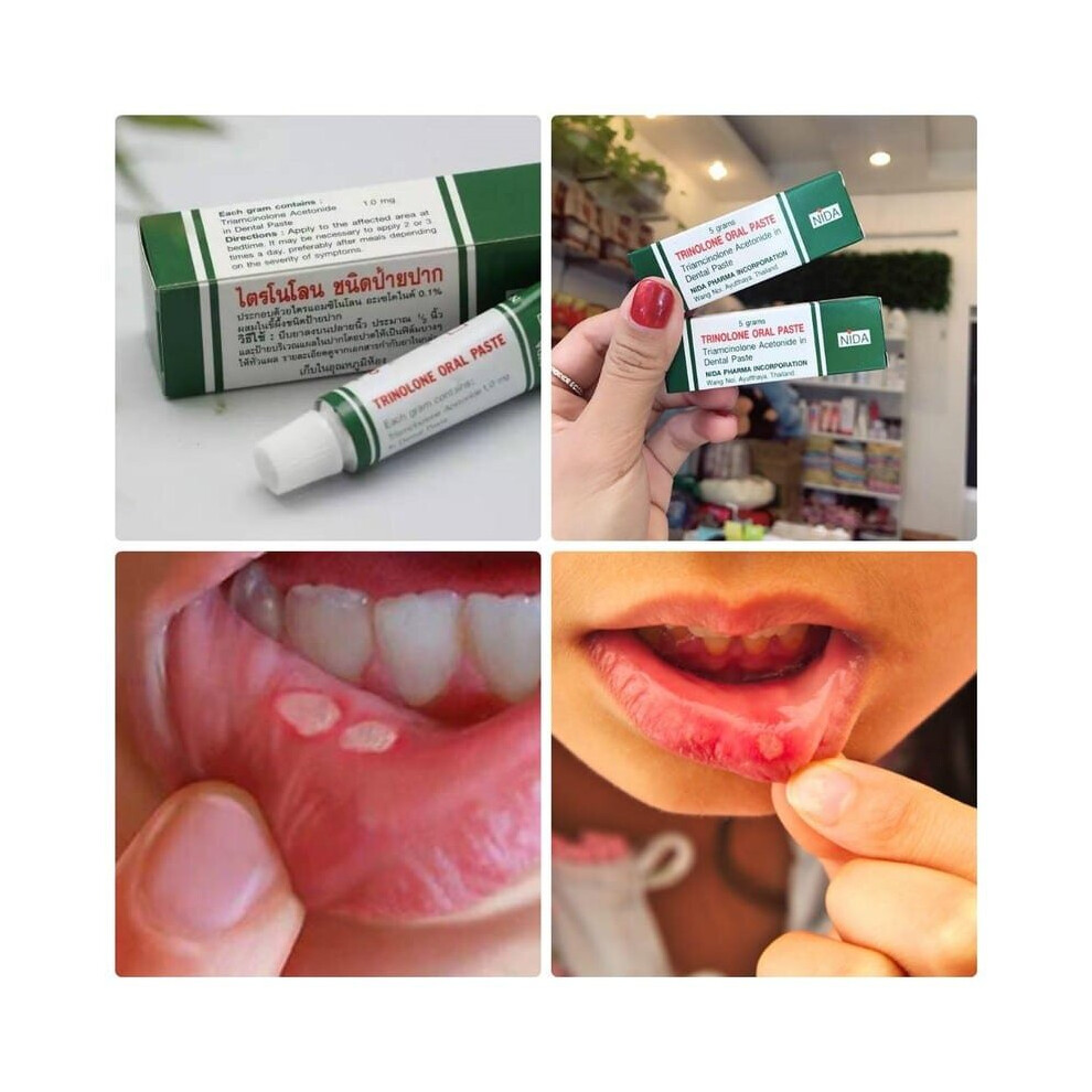 (1pc) Oral Ulcer Ointment Nida Trinolone Oral Paste 5G on OnBuy