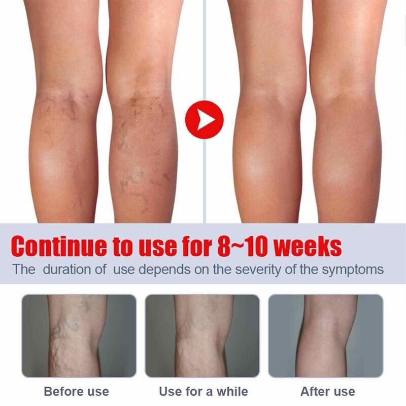Varicose Vein Cream Spider Vein Soothing Leg Balm Spider Vein Treat ...