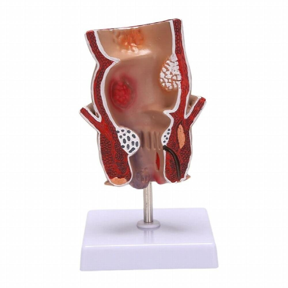 Anatomy Model Human Rectal Hemorrhoid Lesion Model Hemorrhoid Fistula Fistula Fissure Pathology ...