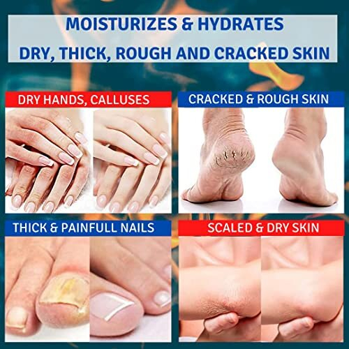 TIS Urea 30% Cream - Heals Severely Cracked, Dehydrated, Irritated Skin ...