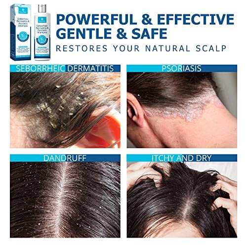 Seborrheic Dermatitis Shampoo, Psoriasis Shampoo, Dandruff Shampoo ...
