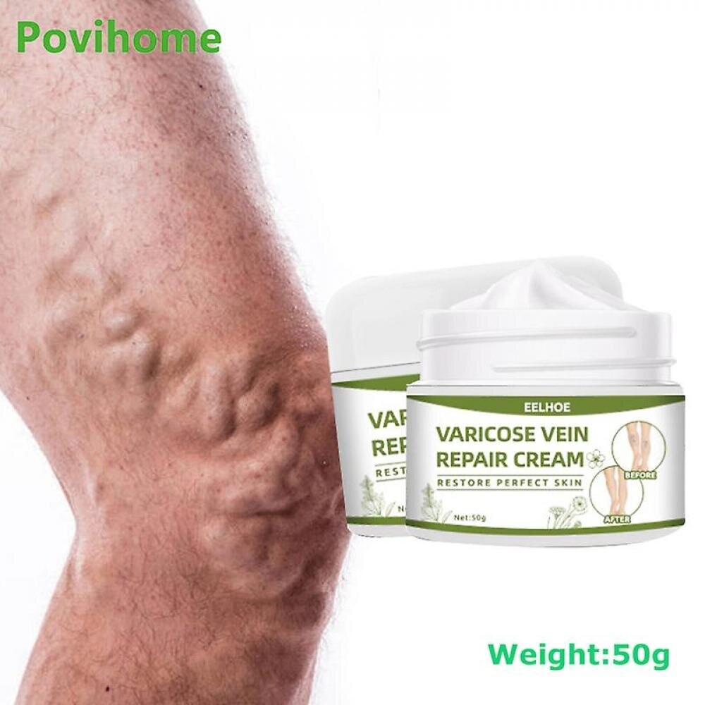 Varicose Vein Cream Thigh Removal Phlebitis Vasculitis Pain Relief ...