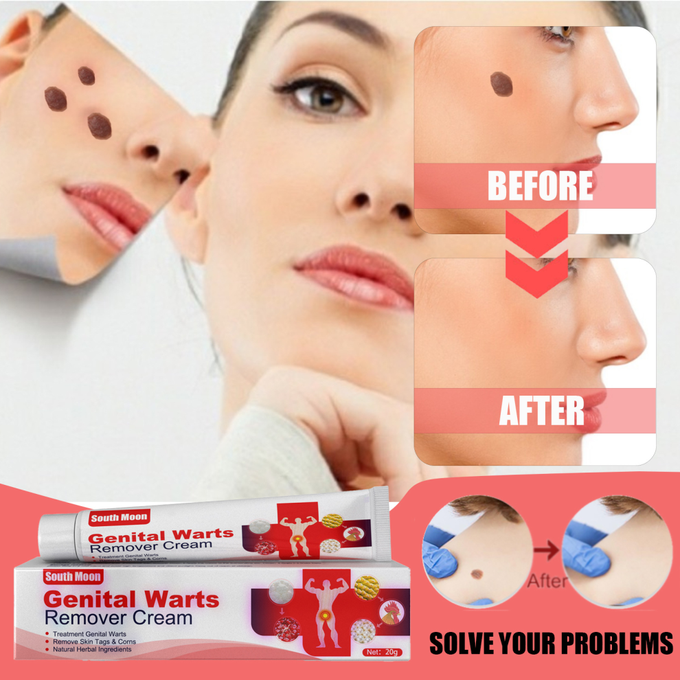 Genital Herpes Wart Remover Ointment Skin Tag Mole Cream 20g on OnBuy