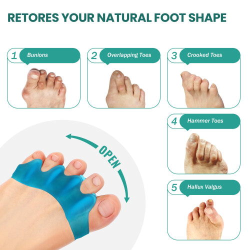 8 Pack Toe Separators, Bunion Corrector for Women/Men, Toe Spacers, Foot Alignment - Dividers to ...