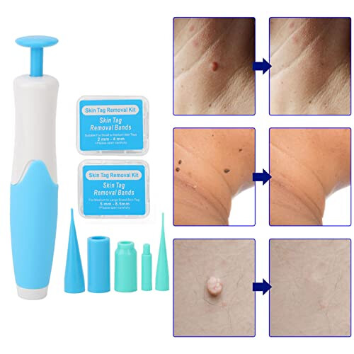 Skin tag Remover Device, Double Head Skin tag Removal tag for Indoor ...