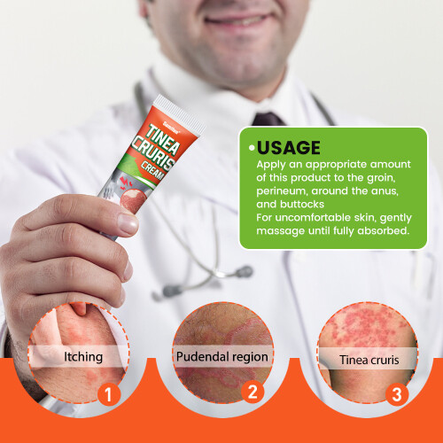 Tinea cruris cream, groin and perianal skin, erythema and papules ...