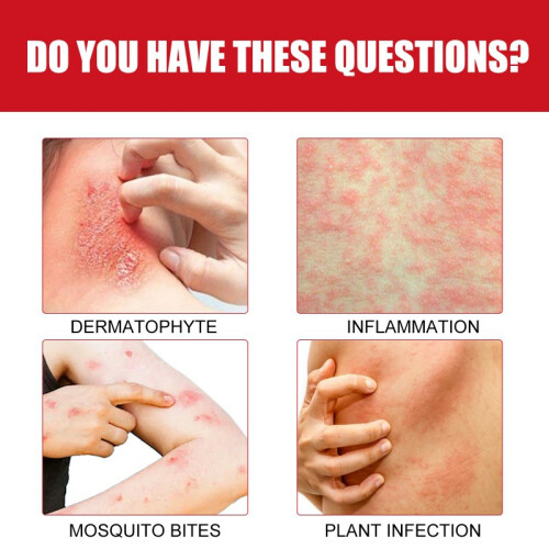 Ximonth Fast Acting Skin Itch Cream For Mosquito Bites Rashes And ...