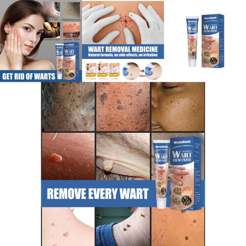 Wart Month West Removal Ointment Effective Solution For Skin Tags And ...