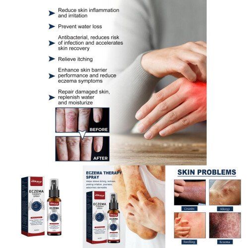 Moon Skin South Care Spray For Relief Of Itchy Skin And Eczema Symptoms ...