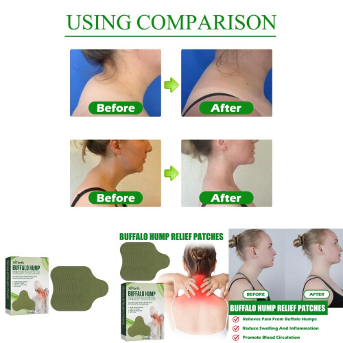 Ximonth Versatile Camel Hump Relief Patches For Targeting Upper Back ...