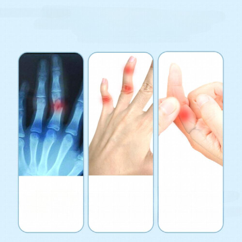 Finger Orthosis Middle Finger Fracture Fixation Splint Finger Guard ...