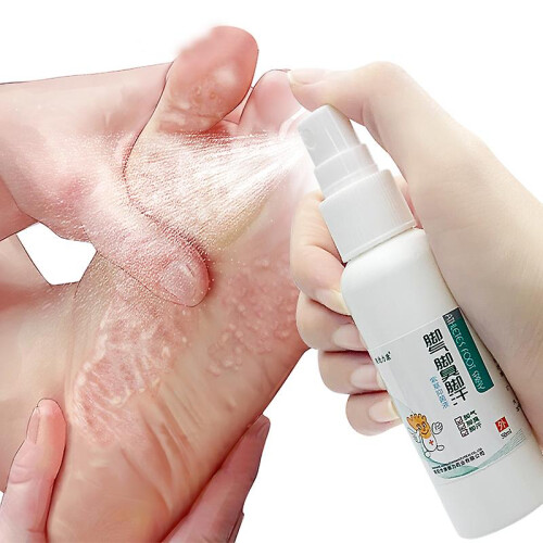 Herbal Athlete Foot Anti-fungal Spray Remove Foot Odor Beriberi Itching ...