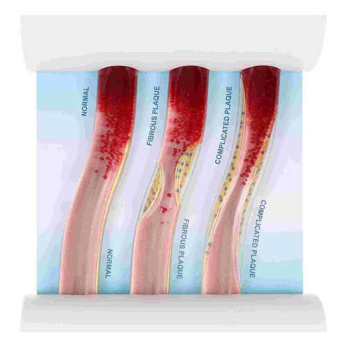 Dynamic Blood Vessel Model Thrombosis Model for Teaching Explanation on ...