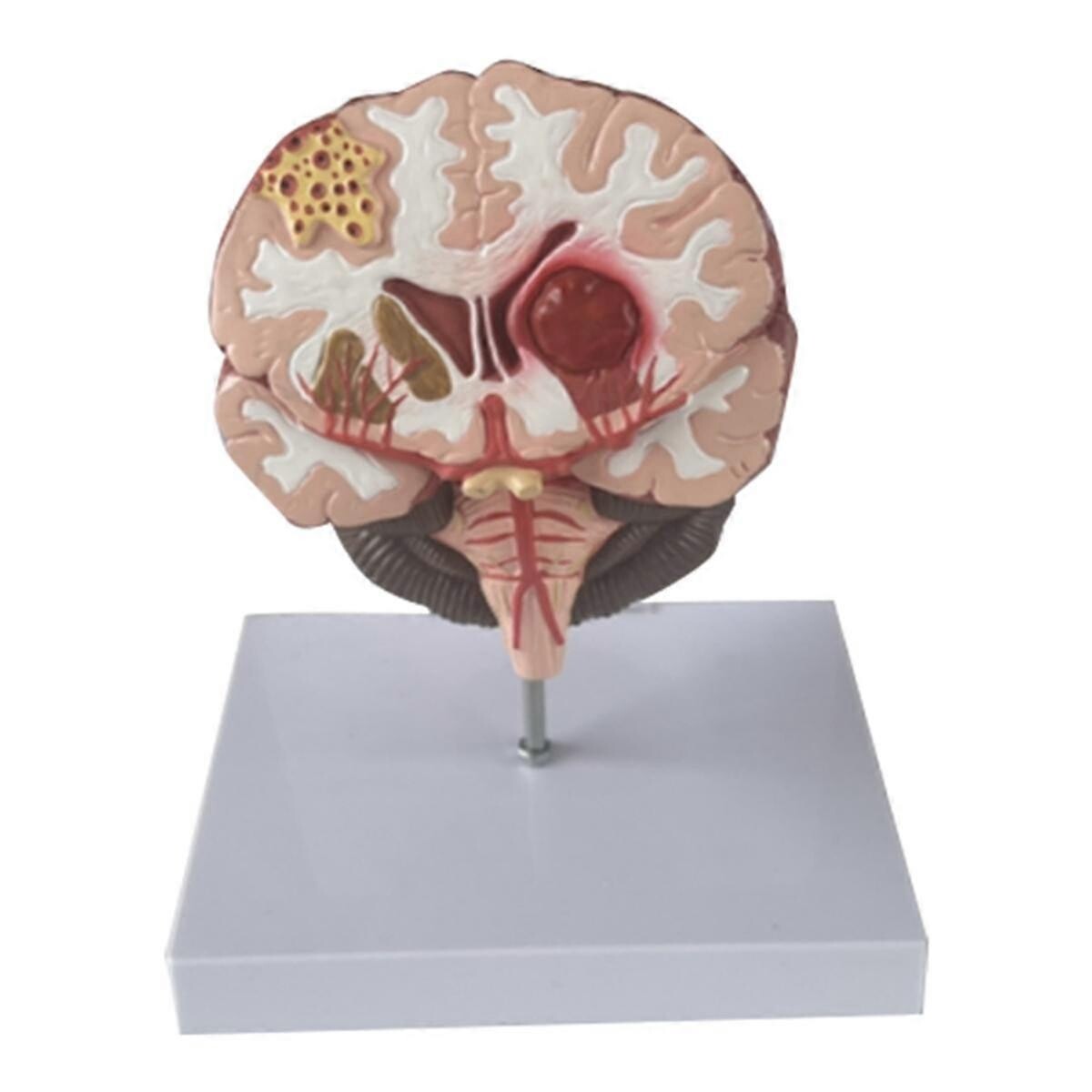 Human Brain Disease Model - Brain Pathology Brainstem Hemorrhage ...