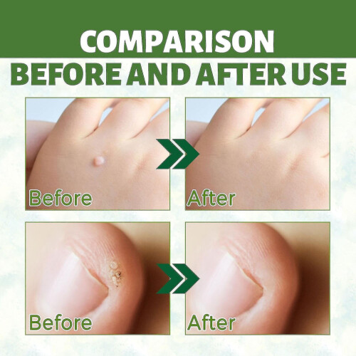 Molluscum Thuja Warts Homeopathy Cream Molluscum Contagiosum In ...