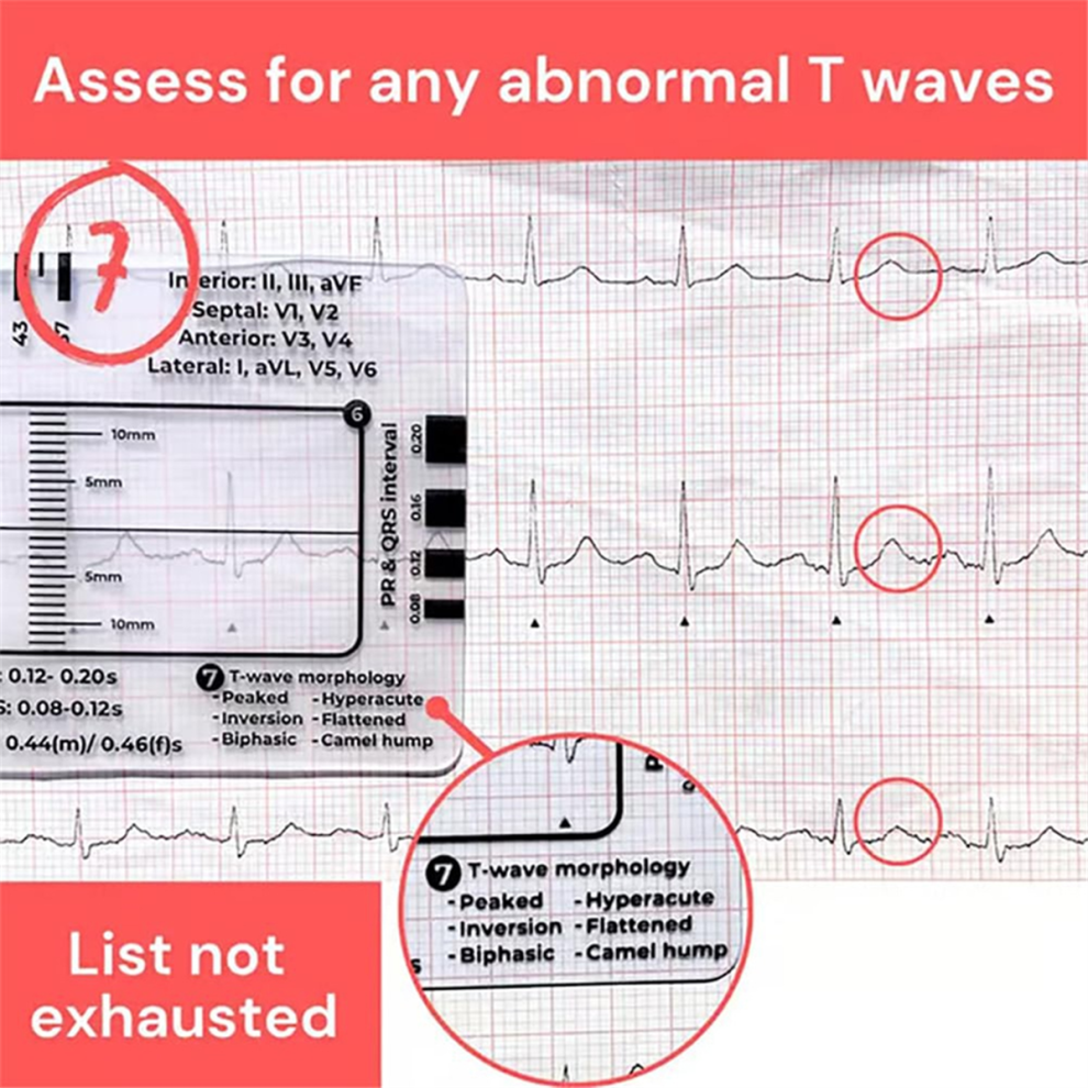 2 reglas de ECG de 7 pasos, regla de ECG de 7 pasos para interpretación de ECG/EKG, on OnBuy
