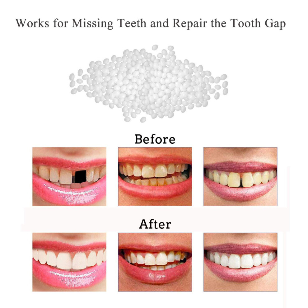 Kit de rparation de dents-perles thermiques pour remplir Fixation de la ...
