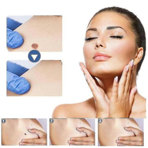 Wart Removal Patch Patch Flesh Nevus Mole Patch --f on OnBuy