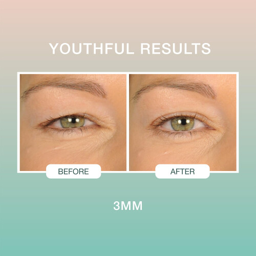 Contours Rx Lids by Design - Non-Surgical & Transparent Eyelid Lift ...