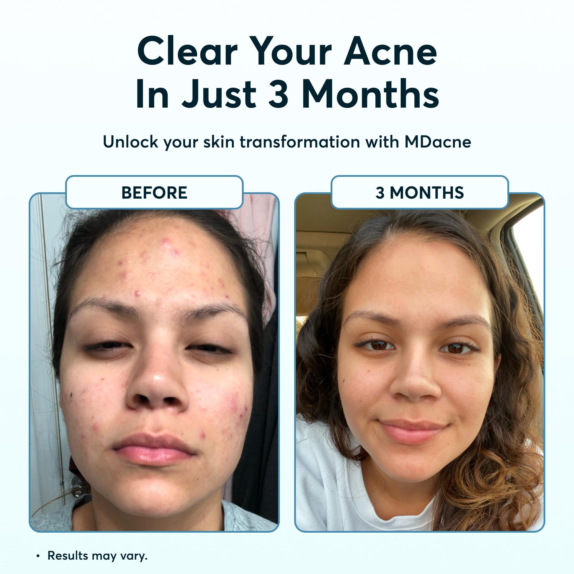MDacne 3-staps Retinol Acne Kit - Retinol Crème 0,25%, Salicylzuur ...
