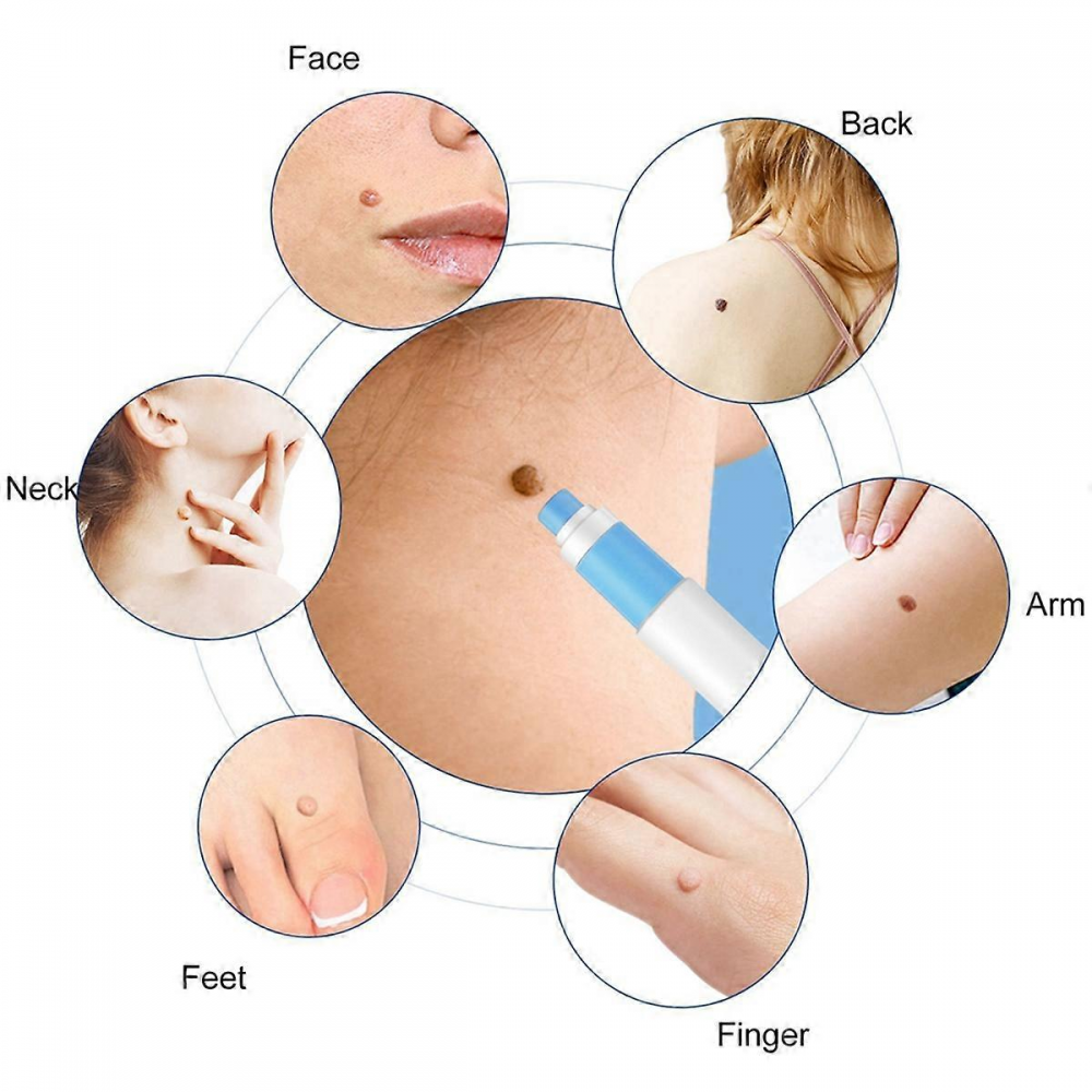 Skin Tag Removal Kit Painless Skin Tag Removal Pen Easy Skin Tag ...