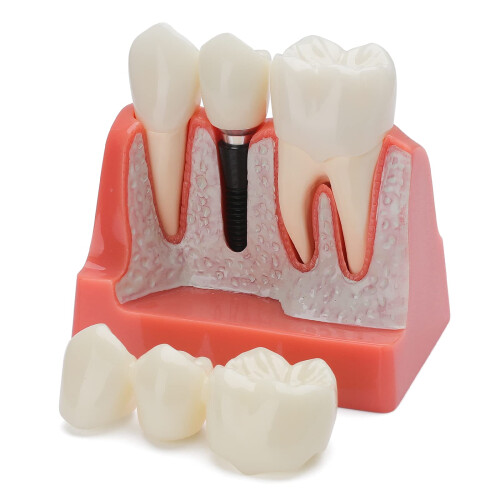 Dental Implant Model - Removable Crown Bridge Demonstration Teeth Model ...