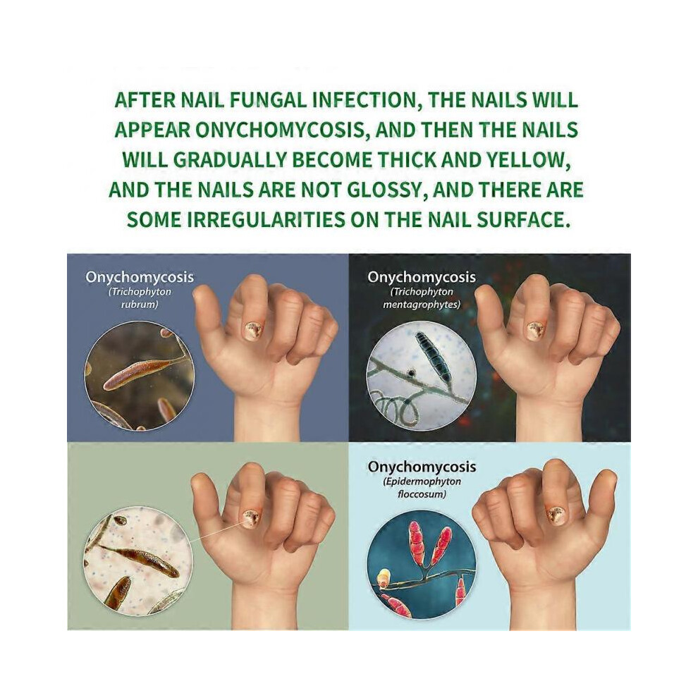 (3pcs) 30ml Nails Care Repair Nail Fungal Anti-fungus Onychomycosis ...
