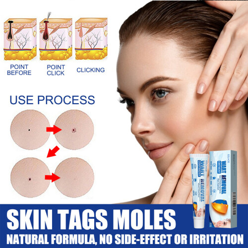 EELHOE Wart Remover Cream 20g Fast Acting Gel Wart ACare Ointment for ...