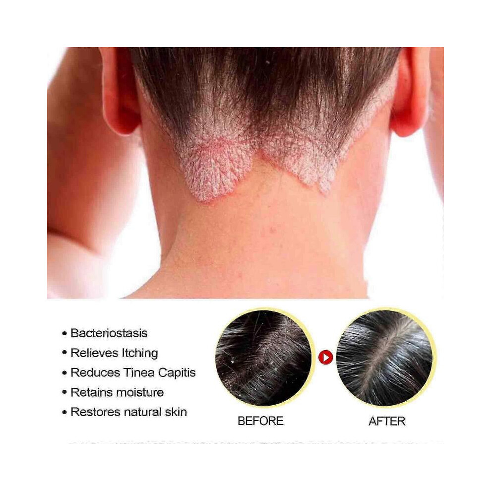 Sulfur Shampoo for Removing Lice, Relieving Itching, Controlling Oil ...