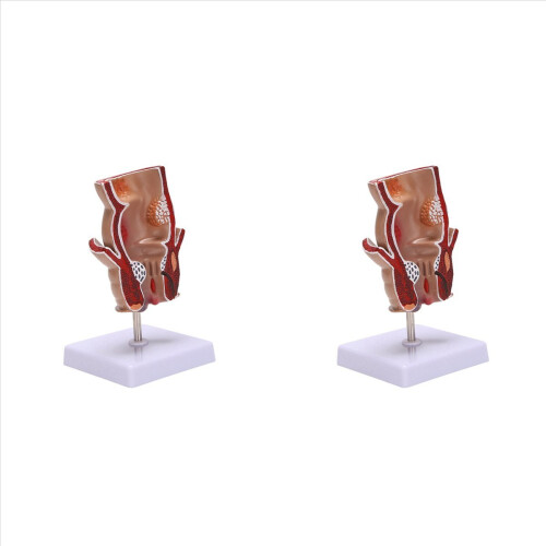 Anatomie Modèle de lésion rectale humaine Modèle d'enseignement de la ...