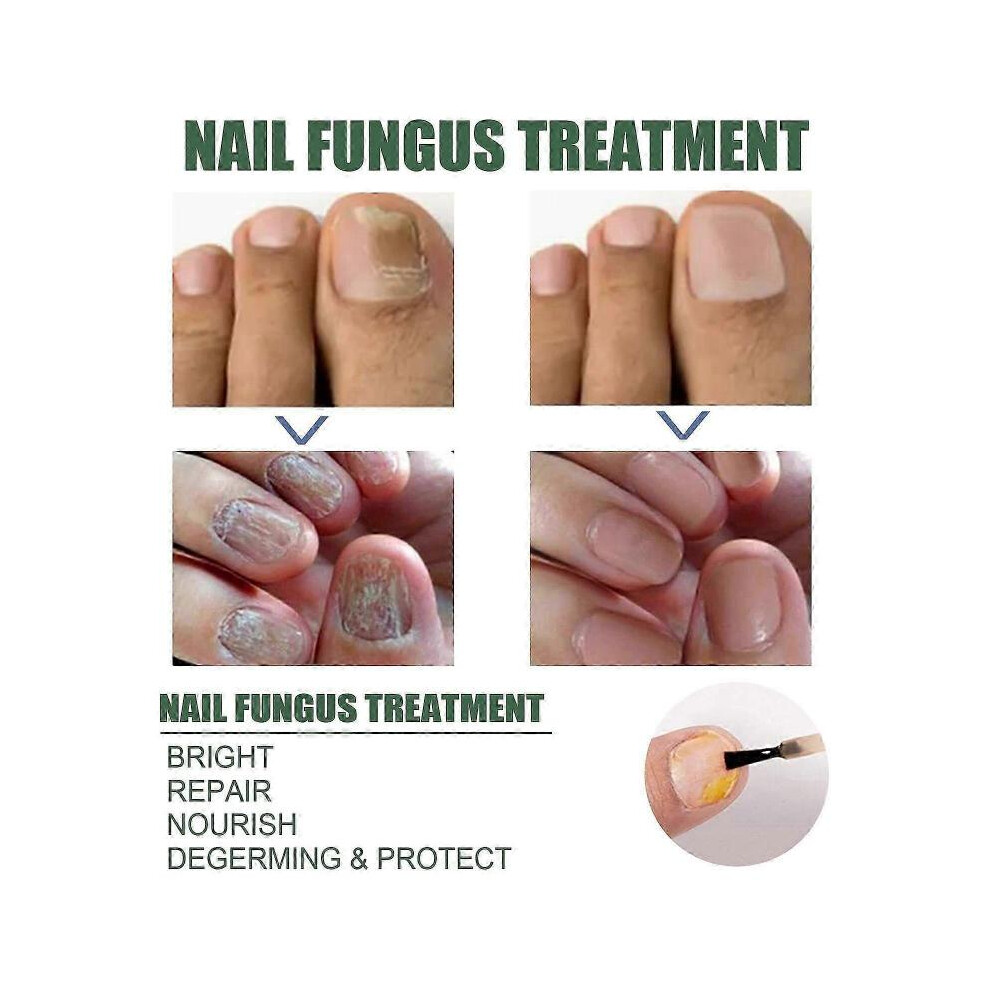 2025 2set Extra Strong Finger & Toenail Fungus Treatment - Best Nail Repair Set, Fungi ...