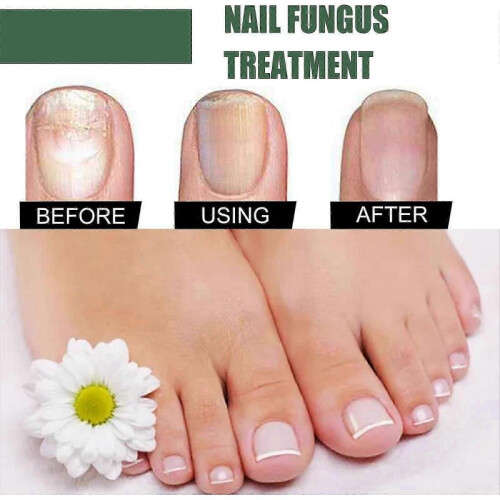 2025 2set Extra Strong Finger & Toenail Fungus Treatment - Best Nail Repair Set, Fungi ...