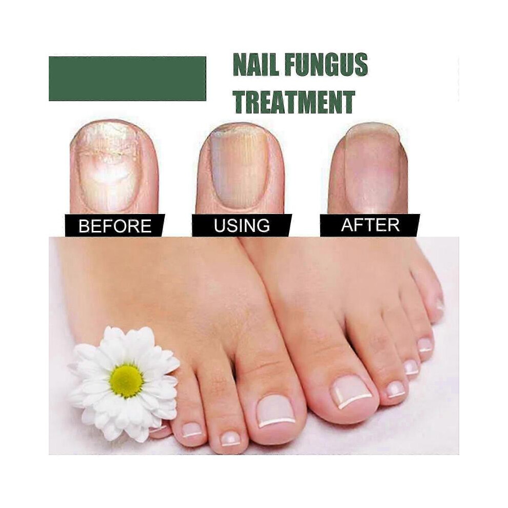 2025 2set Extra Strong Finger & Toenail Fungus Treatment - Best Nail ...
