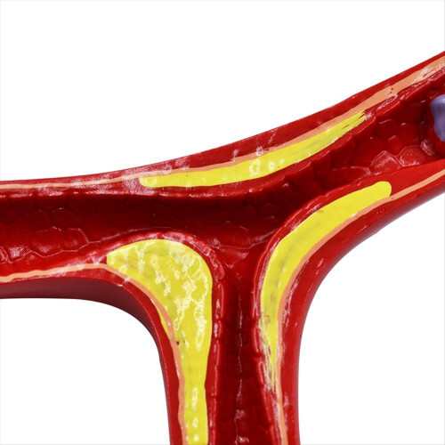 Human Atherosclerosis Cardiovascular Model Vascular Anatomy Branch ...