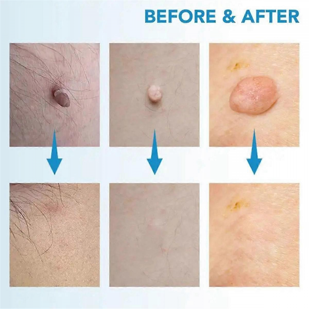 Kit d'élimination des acrochordons, stylo d'élimination des ...