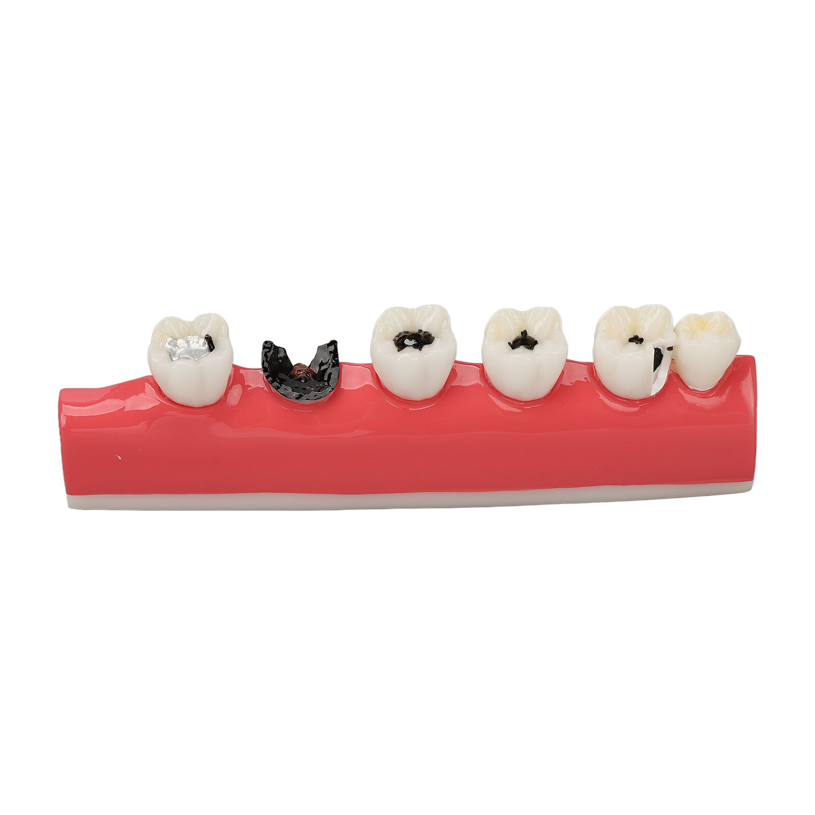 Dental Caries Model 6 Stages Resin Tooth Decay Display Dental Anatomy ...
